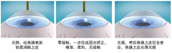 全飞秒、半飞秒、ICL、TPRK...教你分清近视手术区别