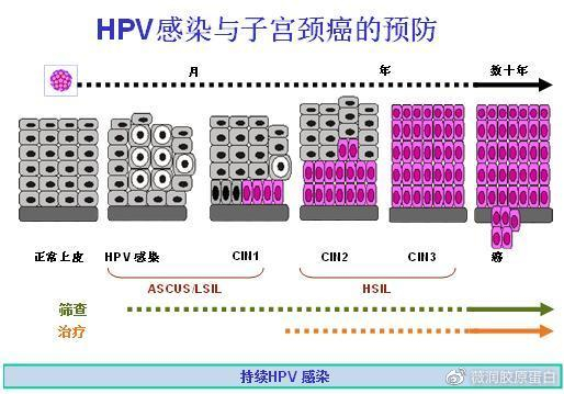 HPV感染到宫颈癌，距离有多远，这篇文章告诉你！|癌症|宫颈癌|病变_新浪新闻