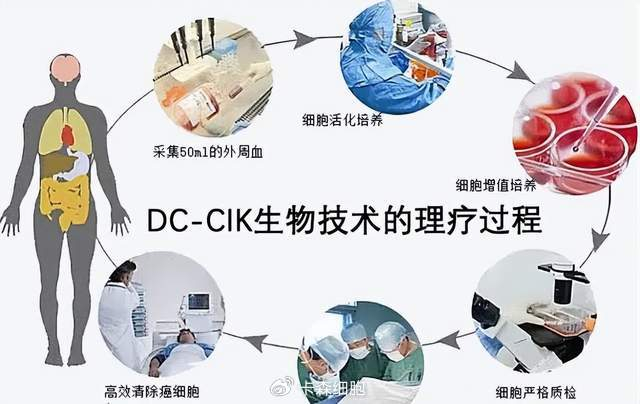 DC-CIK免疫治疗联合化疗对83例晚期肺癌患者的疗效研究|肺癌|化疗|免疫_新浪新闻