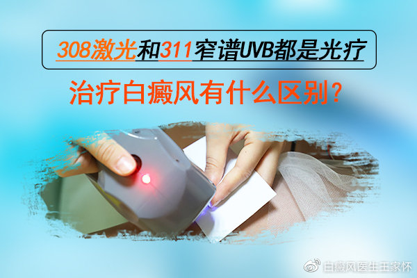 308激光和311窄谱UVB都是光疗，治疗白癜风有什么区别