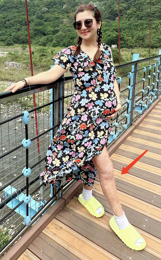 Selina和男友出游，挺孕肚过母亲节，大方晒出双腿烧伤疤痕不自卑