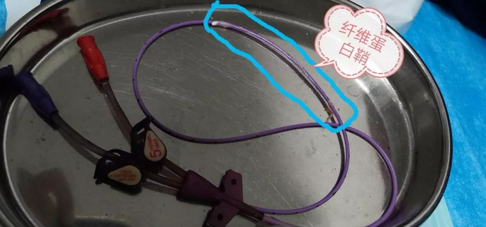 PICC保管268天，长出了什么？看后让人震惊！