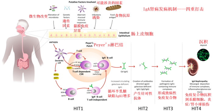 最新进展！又一款IgA肾病新药，将在多家医院开展临床试验！靶向补体途径