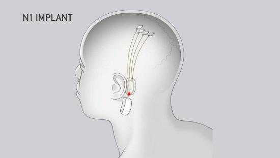 马斯克脑机接口公司 Neuralink 人体试验获得 Fda 批准