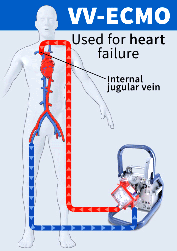 解码——体外膜氧合（ECMO）