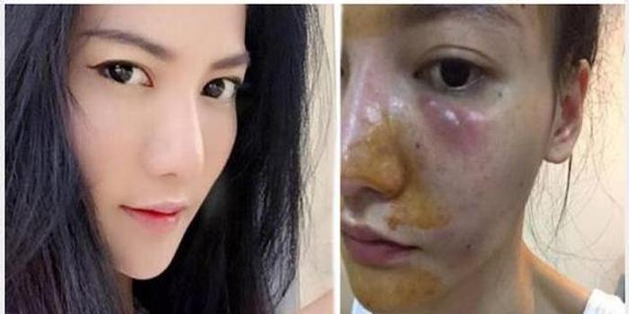 泰国美女连打6年美白针惨遭毁容!美白针究竟能不能打?手机新浪网