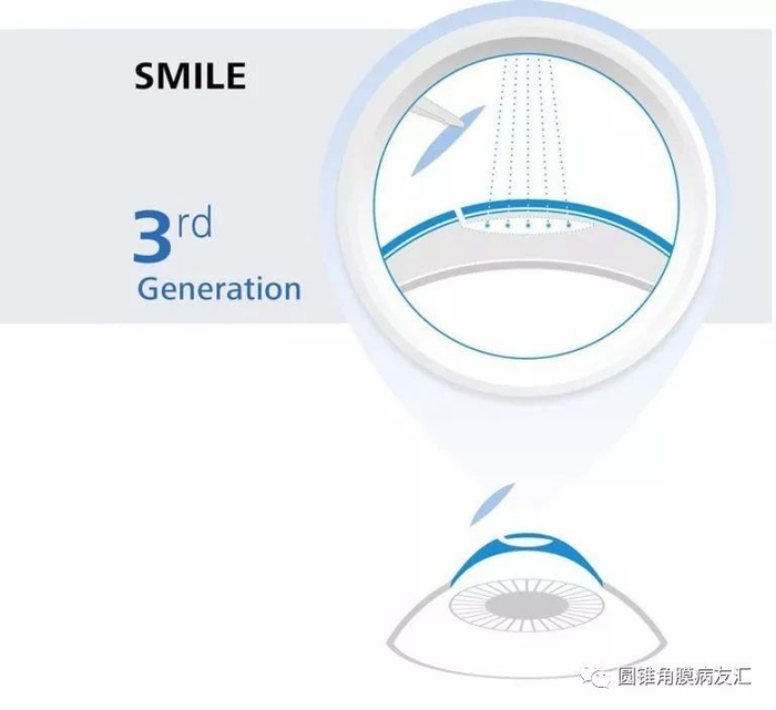 简述PRK、LASEK、LASIK与SMILE激光眼科手术的异同_新浪新闻