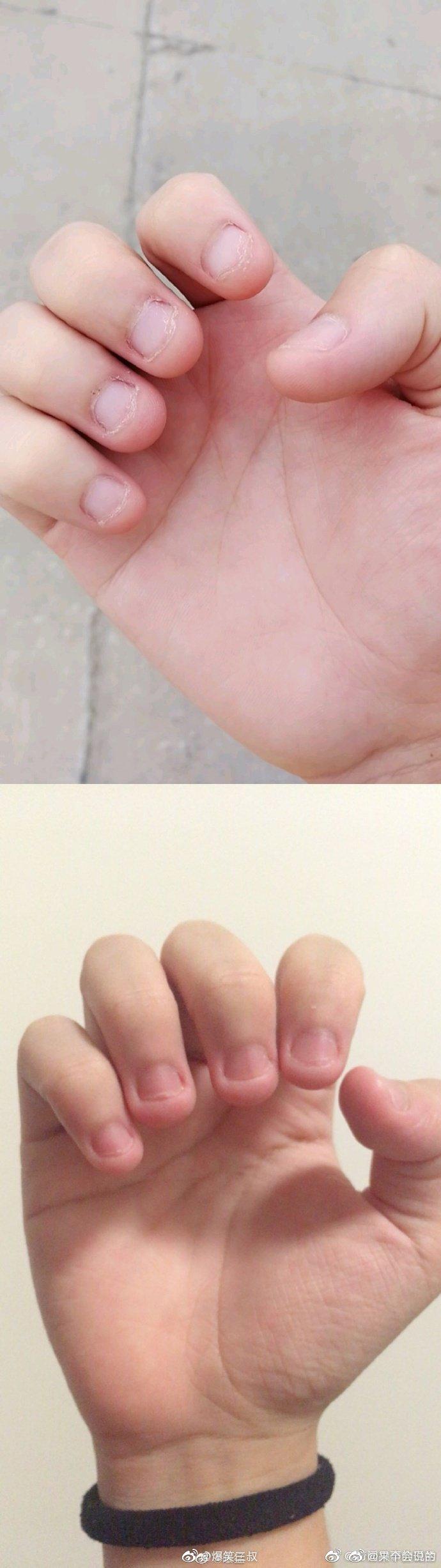 会长期啃指甲的后果