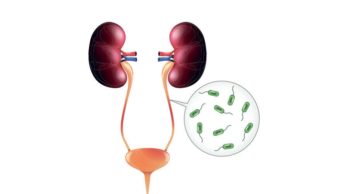 口服抗生素Pivya获批用于治疗女性患者的无并发症尿路感染