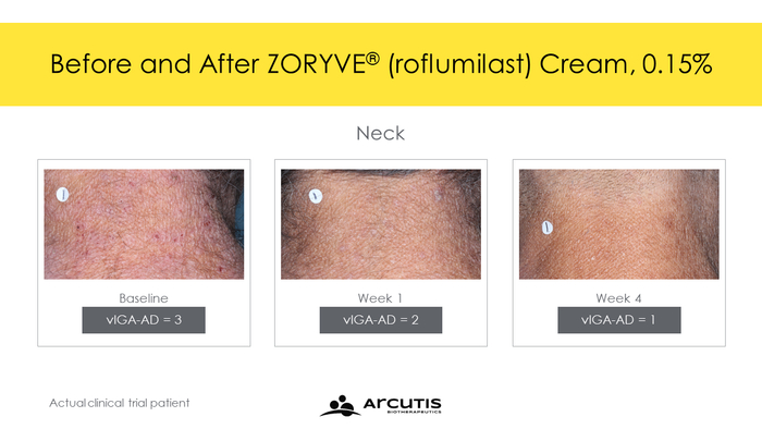 Arcutis获得FDA批准其ZORYVE 0.15%乳膏治疗特应性皮炎|乳膏|特应性皮炎|受试者_新浪新闻