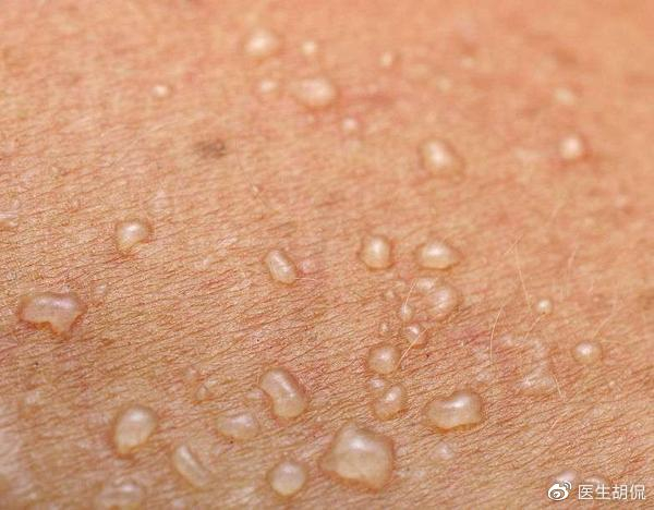 让人痛苦不堪的“缠腰龙”是怎么感染的？该如何治疗？一文科普！|疱疹|带状疱疹|传染科|疫情|疾病_新浪新闻