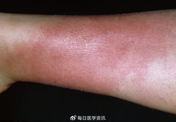 22.蜂窝组织炎-细菌性皮肤病|细菌|蜂窝组织炎|感染_新浪新闻