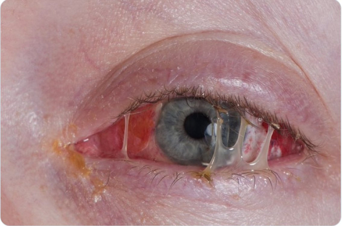 淋病结膜炎 眼部呈现明显的红肿，结膜高度充血，常伴有“肉样”外观|淋病|结膜炎_新浪新闻