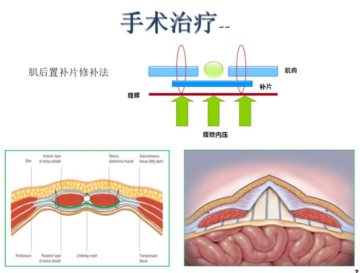 腹腔镜完全腹膜外Sublay修补术治疗切口疝，微创又美观|腹壁|科为|梅州市|门诊大楼_新浪新闻