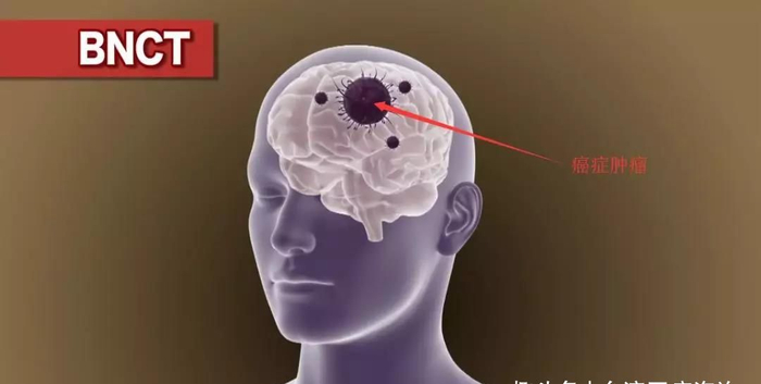 BNCT “贪吃”的癌细胞