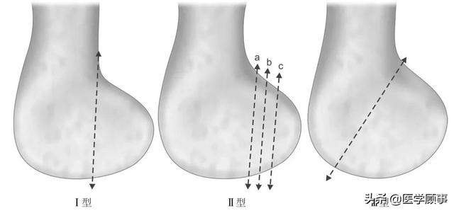 Hoffa骨折如何处理？