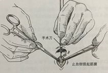 腹腔镜穿刺法 | Hasson穿刺法