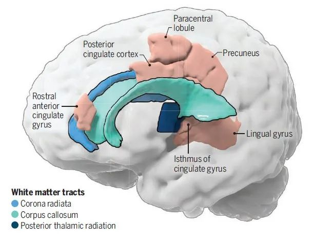 Science：大脑常常“被忽视的部分”，朱宏图团队分析4.4万人脑数据，发现了其重要性！|遗传变异|微结构|脑白质|灰质|遗传_新浪新闻