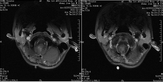 “绝症”不绝望 声动力治疗复发脑干胶质瘤在郑大一附院获得成功|脑干|胶质瘤|肿瘤