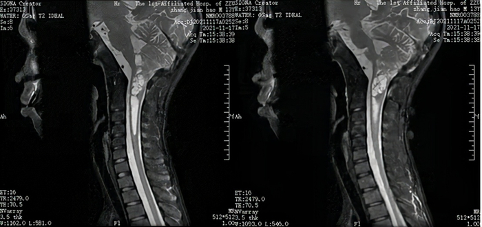 “绝症”不绝望 声动力治疗复发脑干胶质瘤在郑大一附院获得成功|脑干|胶质瘤|肿瘤