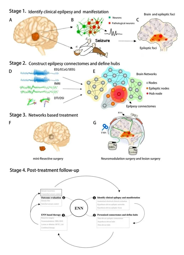 Life Med观点｜癫痫脑网络外科的脑网络连接组学变革|癫痫|外科_新浪新闻