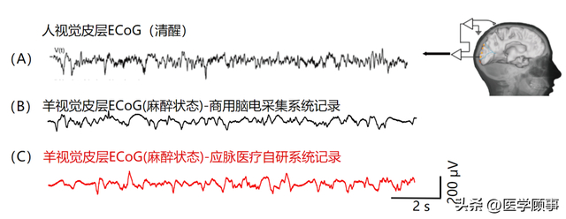 应用血管内支架电极成功记录到特定脑区脑电信号|脑机接口|信号_新浪新闻