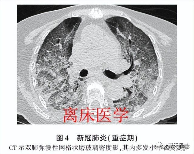新型冠状病毒肺炎胸部CT临床实例