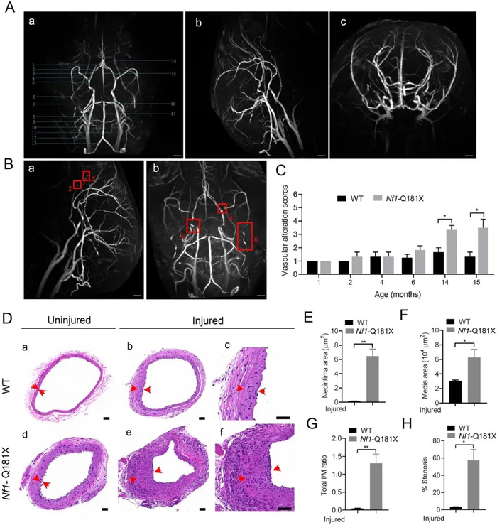 NB：首医霍丽蓉教授报道Nf1基因Q181X点突变致脑血管狭窄