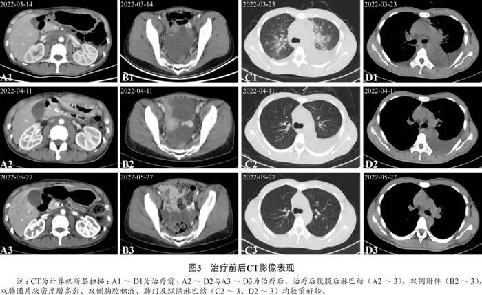 普拉替尼靶向治疗RET基因融合阳性消化系统肿瘤