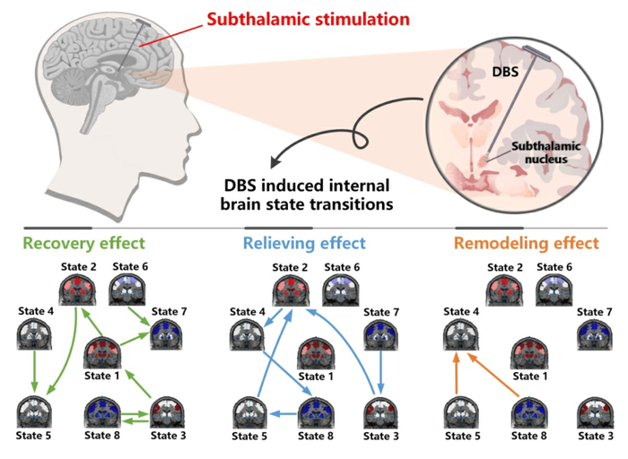 Brain：张陈诚/李殿友/刘晨合作报道丘脑底核DBS调控PD运动网络|天津大学_新浪新闻