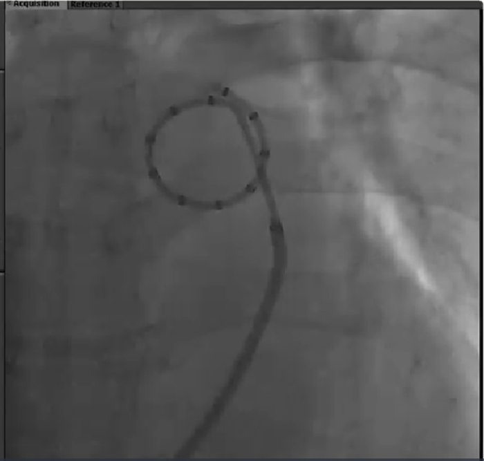 全球首例｜四川省人民医院完成PADN-HF-PH研究全球首例入组，PADN心衰开启国内多点布局|手术|临床试验|四川省人民医院_新浪新闻