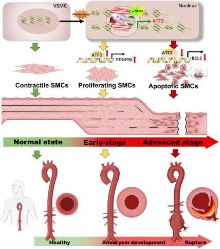 Circ Res | 广州医科大学邓伟豪/张媛等团队合作揭示血管平滑肌细胞ATF3时空性驱动腹主动脉瘤形成新机制|广州医科大学_新浪新闻