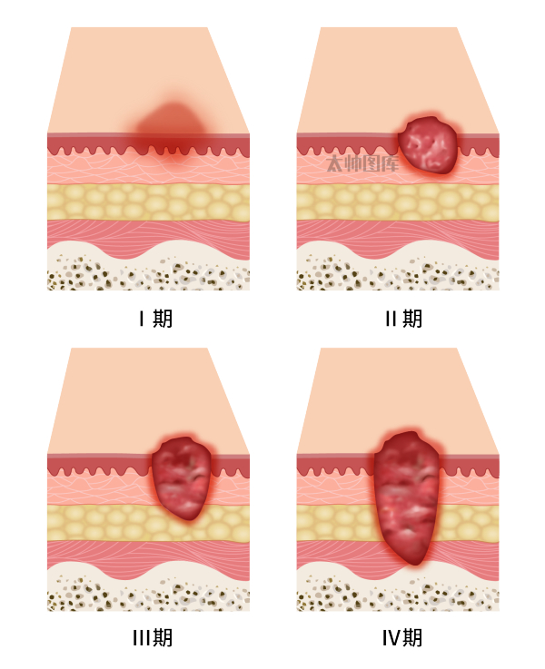 新指南SPIPP 2.0：压伤预防标准化方案2.0版__财经头条