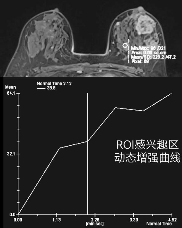 乳腺磁共振检查（MRI）您了解吗？哪些人需要做？看这一篇就够了|乳腺|乳腺癌|肿瘤_新浪新闻