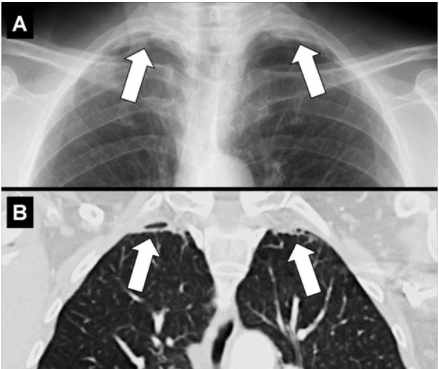 「33张」经典胸部影像图全面总结，入门必学！|支气管|肺不张|胸膜|肺气肿|箭头_新浪新闻