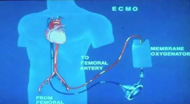疫情关键时刻救命的ECMO:全国只有400台 为何这么少？_手机新浪网