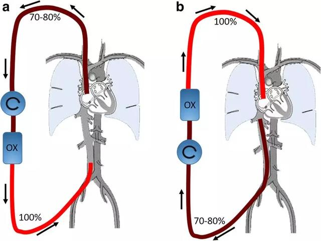 解码——体外膜氧合（ECMO）|肺部|疾病|新冠肺炎_新浪新闻