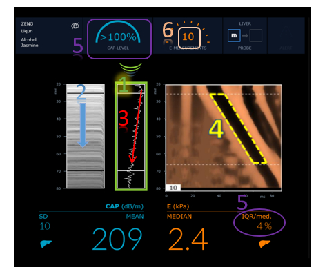 FibroScan® 无创肝脏检测的报告单如何看？|肝脏_新浪健康_新浪网