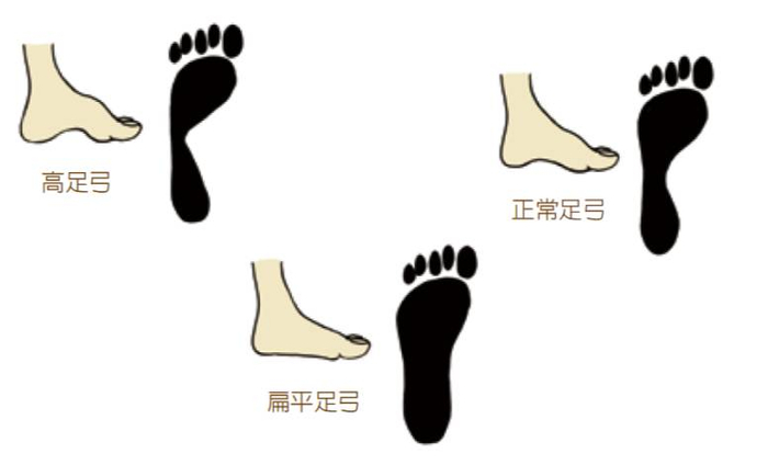 扁平足的判别方法与治疗方式_手机新浪网